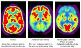PET/CT in Neurology | Transforming Epilepsy & Dementia Care | Akumin
